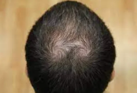 Penyebab Rambut Botak di Usia Muda dan Cara Mengatasinya - Thehok.id